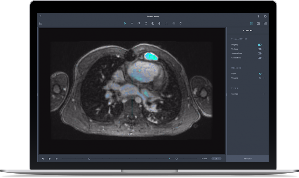 Arterys 4D Blood Flow MRI Imaging System Cleared by FDA | Innovation ...